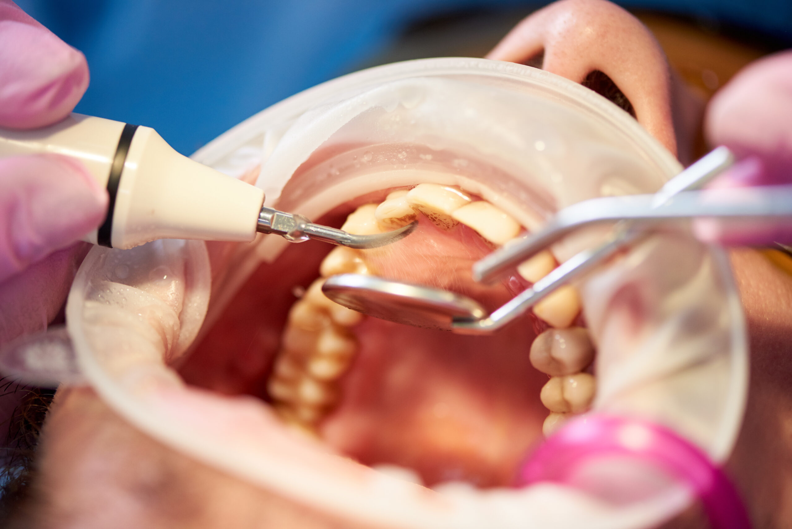 Preprosthetic Surgery for Denture Preparation | El Paso TX - Prestige ...